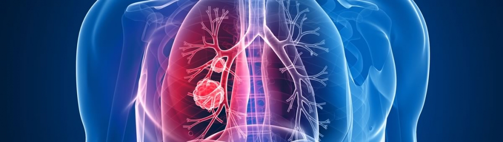 Snelle diagnose bij verdenking op longkanker - LIVESTRONG _NL